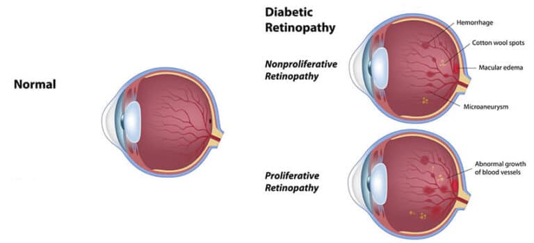 Retina Specialist New Lenox | Diabetic Eye Care Lemont, IL